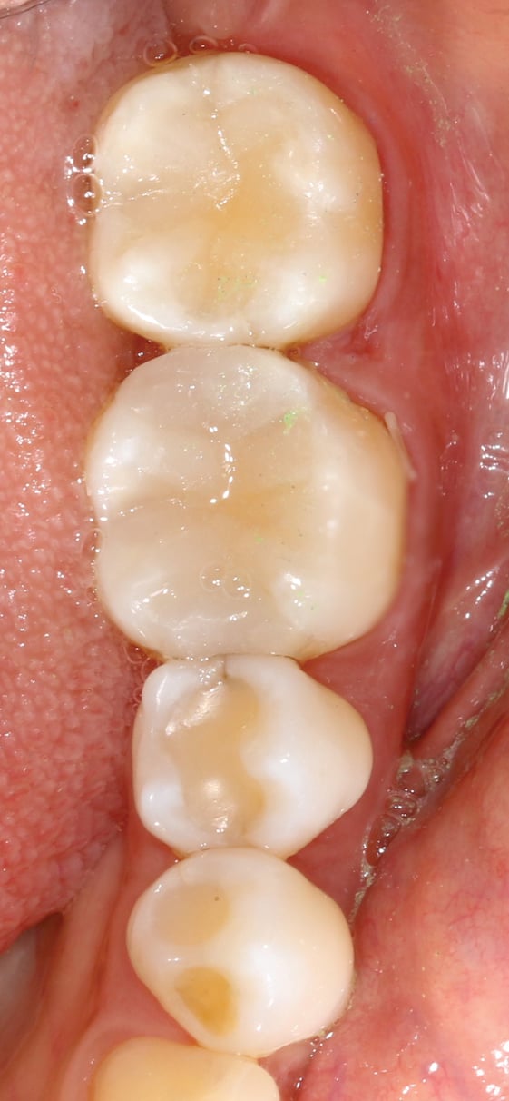 Clinical Guide: Transcend Composite